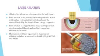 Laser ablation | PPTX