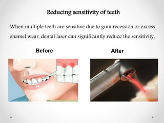 Laser Root canal treatment in chennai | PDF
