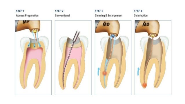 Laser in Endodontics