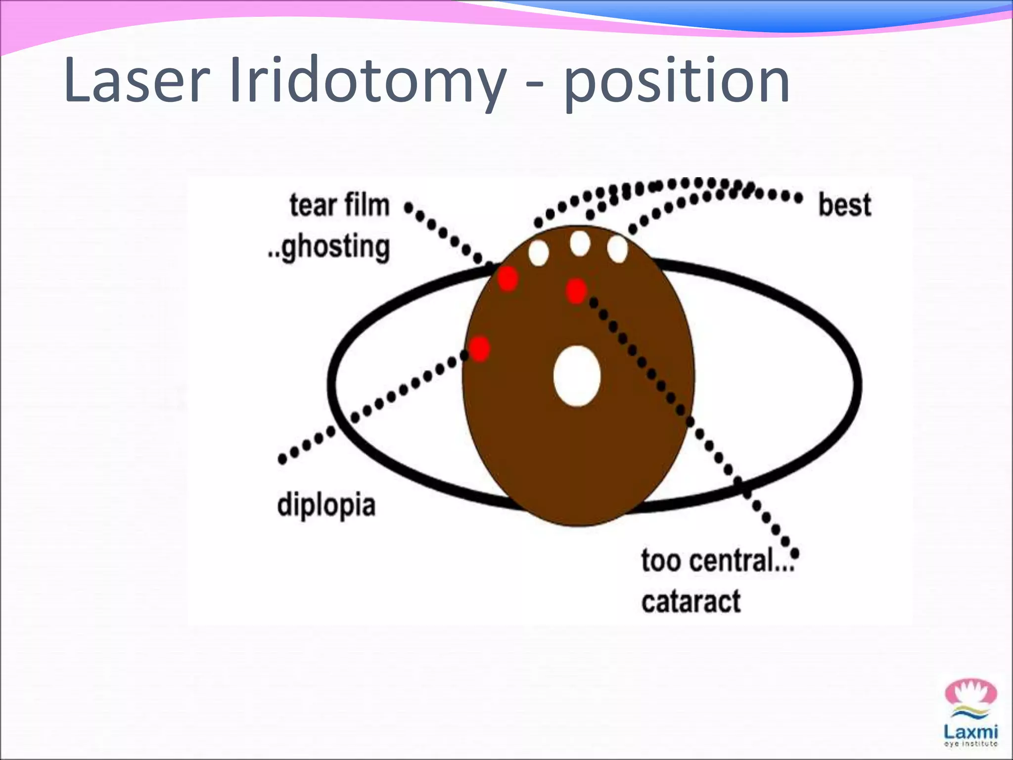 Lasers in Glaucoma | PPTX