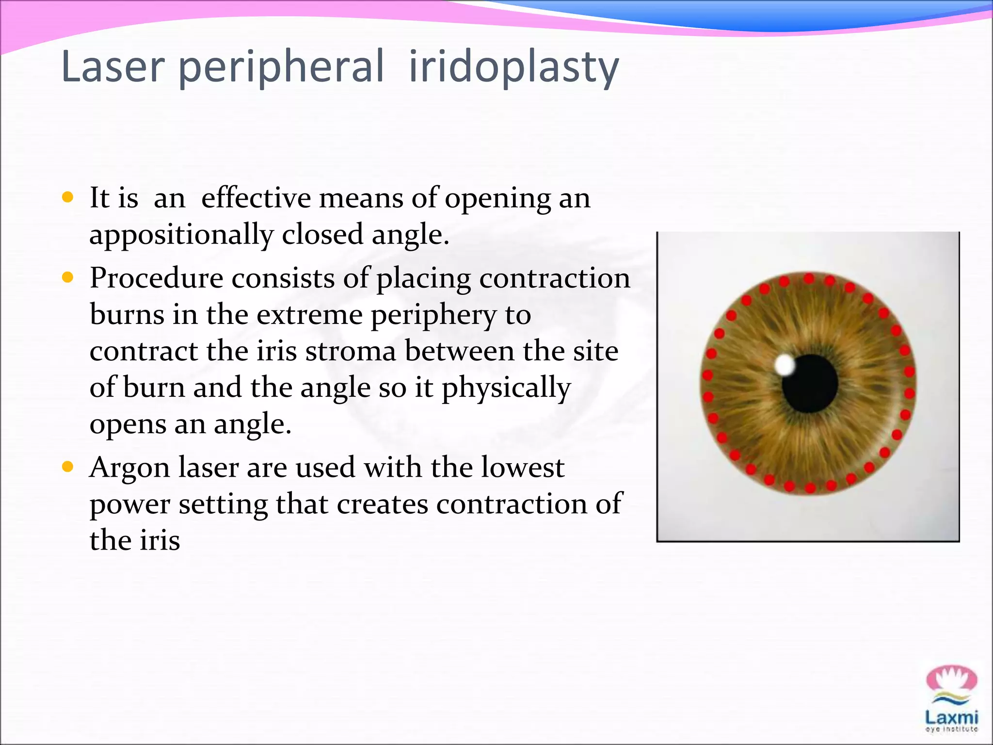 Lasers in Glaucoma | PPTX