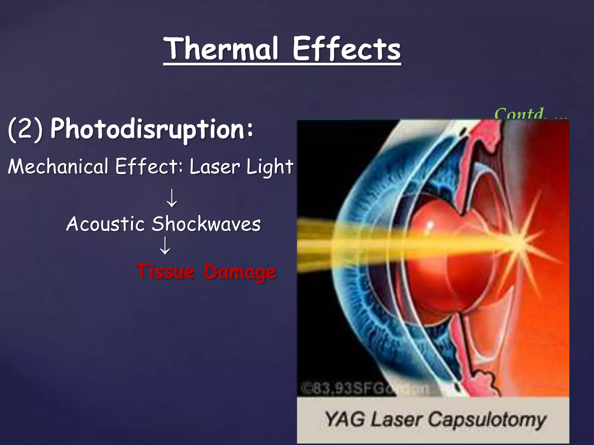 Laser in ophthalmology | PPTX