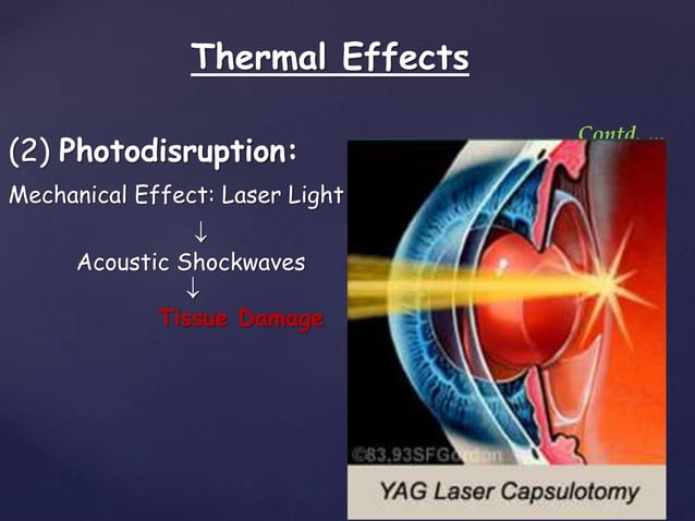 Laser in ophthalmology | PPTX | Eye and Vision Conditions | Diseases ...