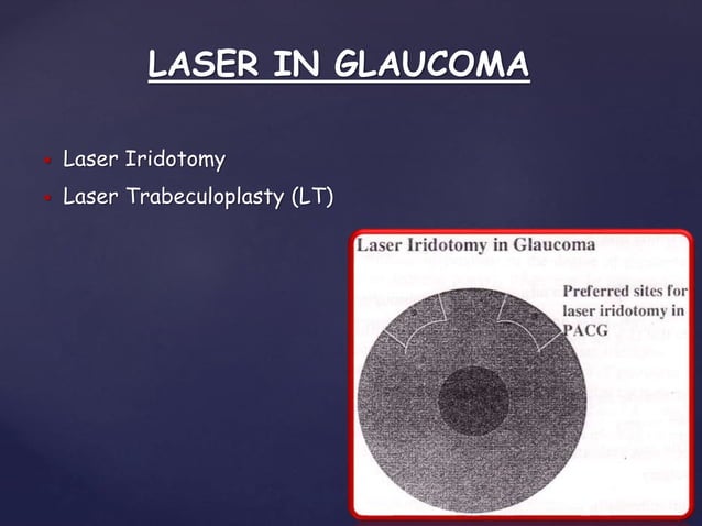 Laser in ophthalmology | PPTX | Eye and Vision Conditions | Diseases ...