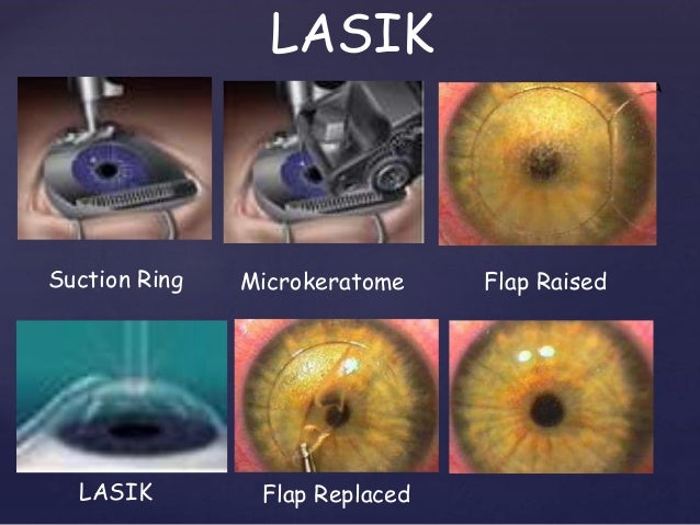 Laser in ophthalmology