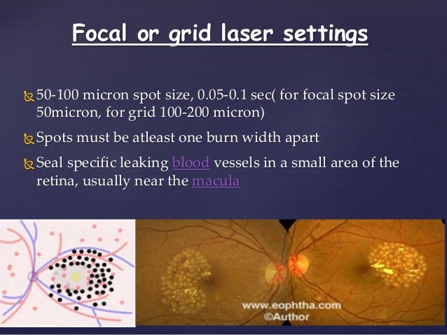 Laser in ophthalmology