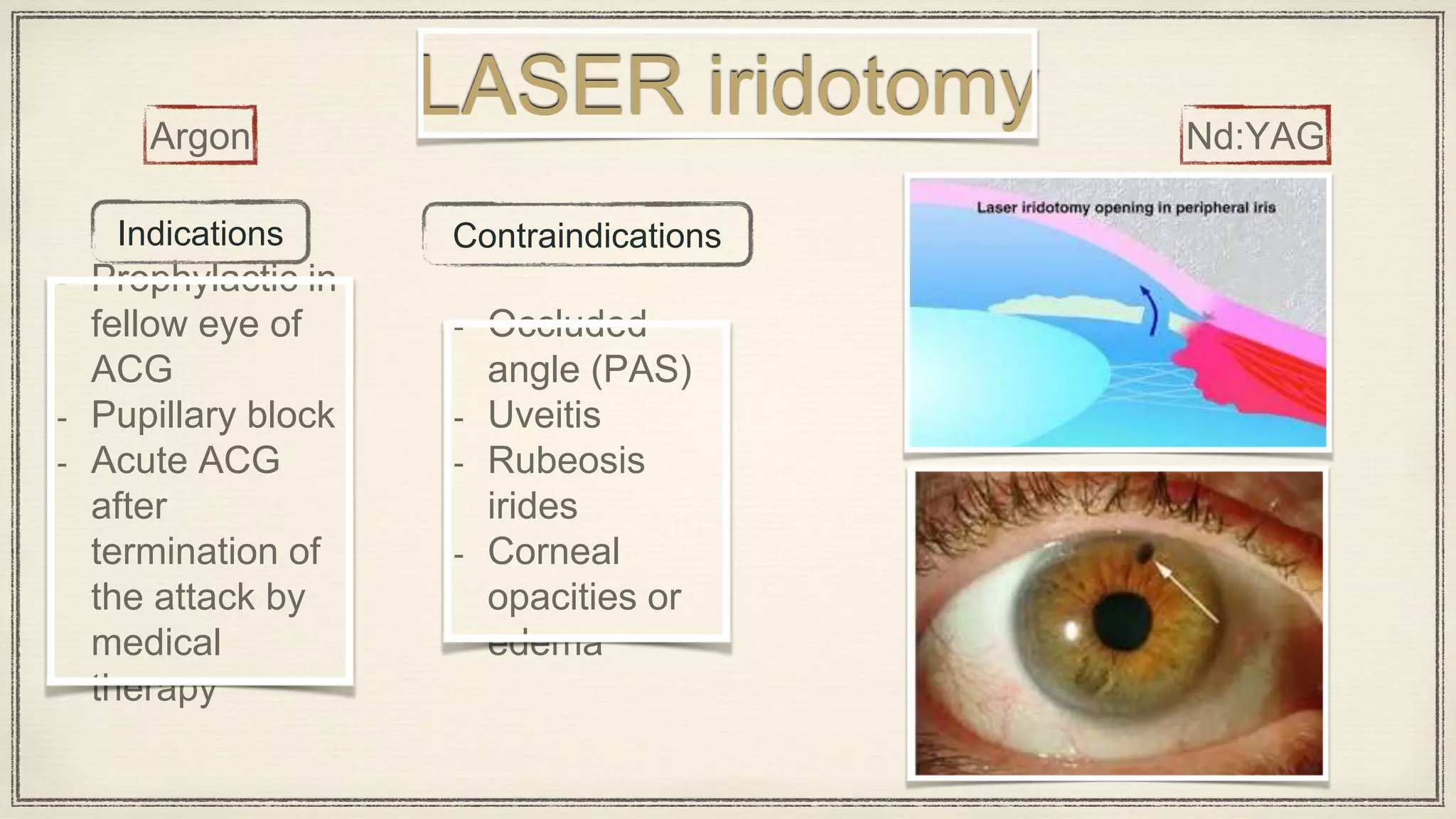 Laser in ophthalmology | PPTX