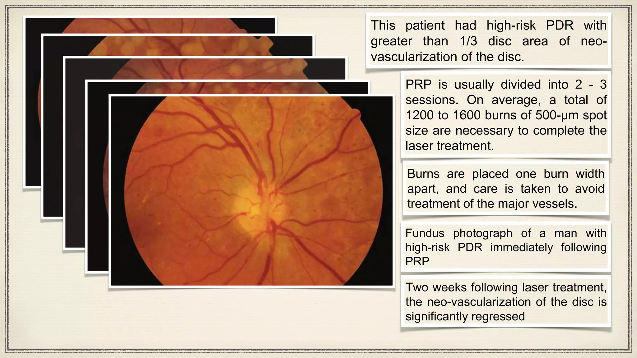 Laser in ophthalmology | PPTX
