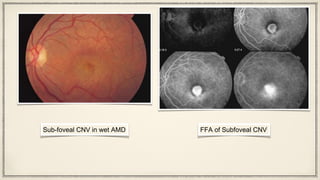 Laser in ophthalmology | PPTX