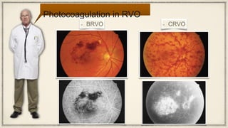 Laser in ophthalmology | PPTX