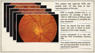 Laser in ophthalmology | PPTX