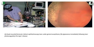 Laser in Ophthalmology and types of Laser | PPTX