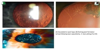Laser in Ophthalmology and types of Laser | PPTX