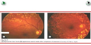 Laser in Ophthalmology and types of Laser | PPTX