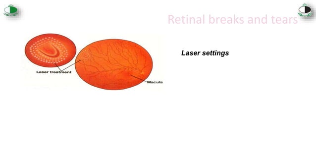 Laser in Ophthalmology and types of Laser | PPTX