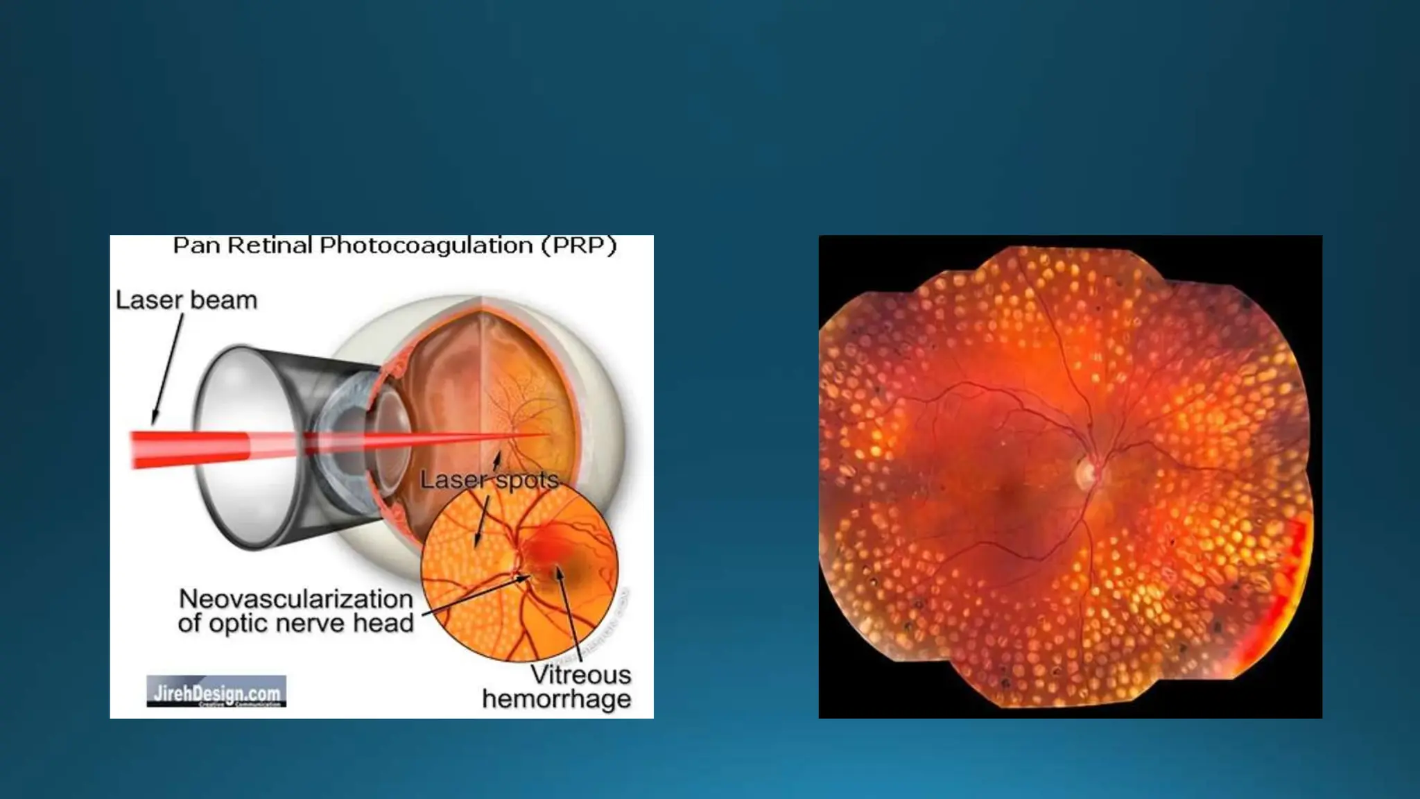 LASERS IN OPHTHALMOLOGY Presentation .pptx | Eye and Vision Conditions ...