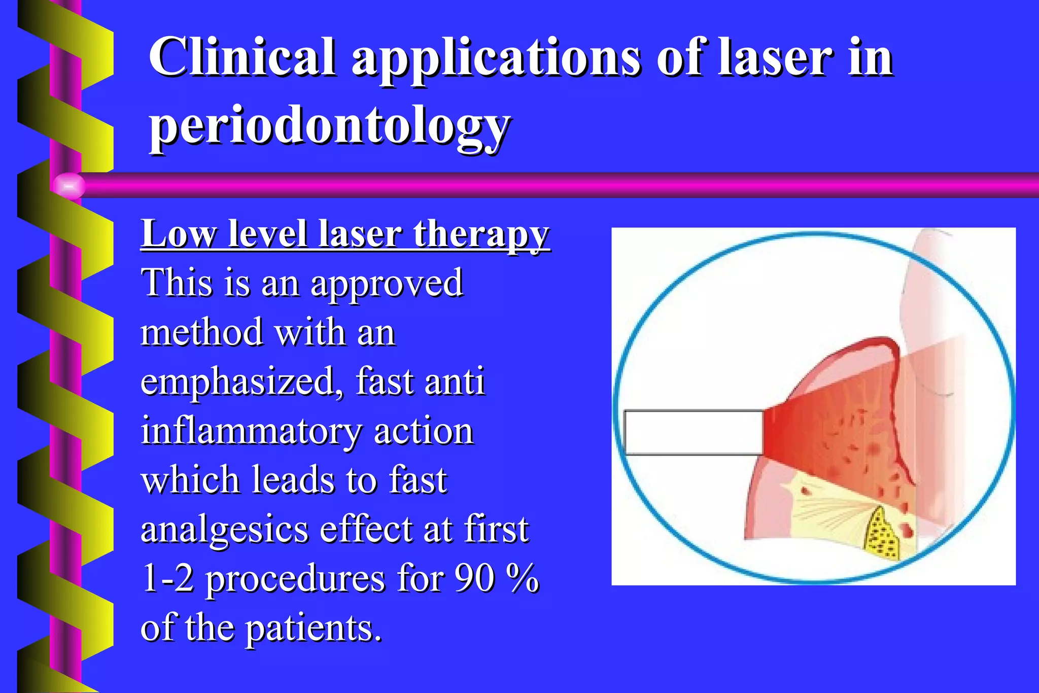 Laser in periodontology | PPT