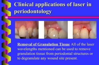 Laser in periodontology | PPT