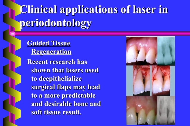 Laser in periodontology | PPT