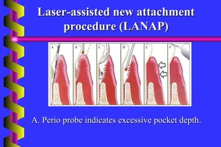 Laser in periodontology | PPT