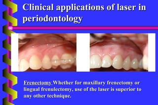 Laser in periodontology | PPT