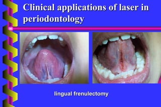 Laser in periodontology | PPT