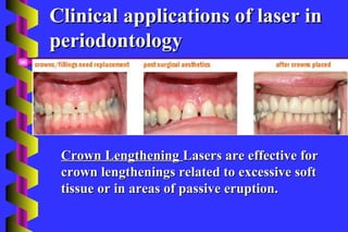 Laser in periodontology | PPT