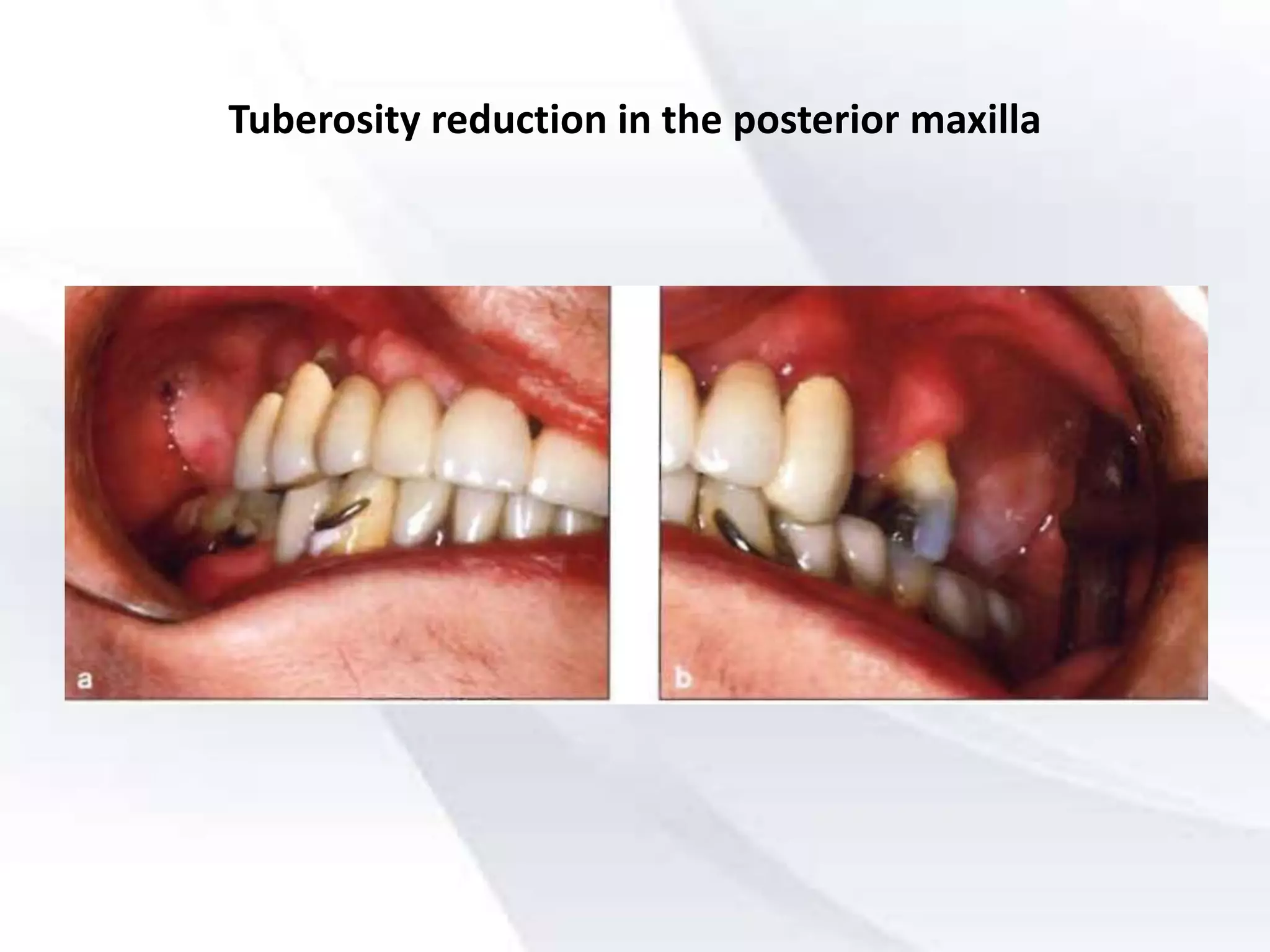 Laser in prosthodontics | PPTX