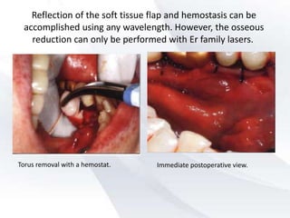 Laser in prosthodontics | PPTX