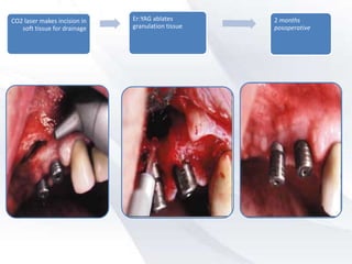 Laser in prosthodontics | PPTX