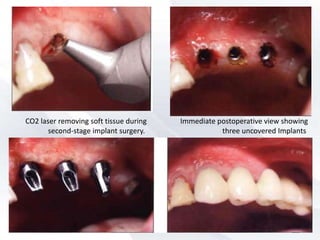 Laser in prosthodontics | PPTX