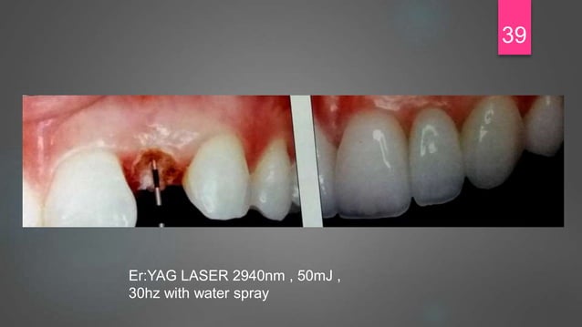 Laser in prosthodontics | PPT