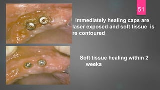 Laser in prosthodontics | PPTX