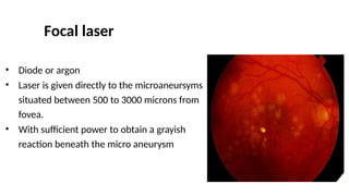 Laser in retina Ophthalmology By Dr. Eva | PPTX