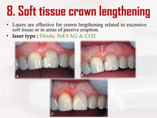 Laser in surgical periodontics | PDF | Dental Health | Diseases and ...