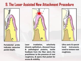 Laser in surgical periodontics | PDF