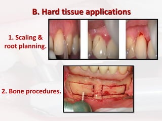 Laser in surgical periodontics | PDF | Dental Health | Diseases and ...