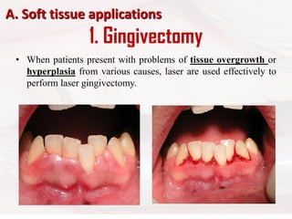 Laser in surgical periodontics | PDF