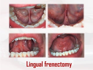 Laser in surgical periodontics | PDF | Dental Health | Diseases and Conditions