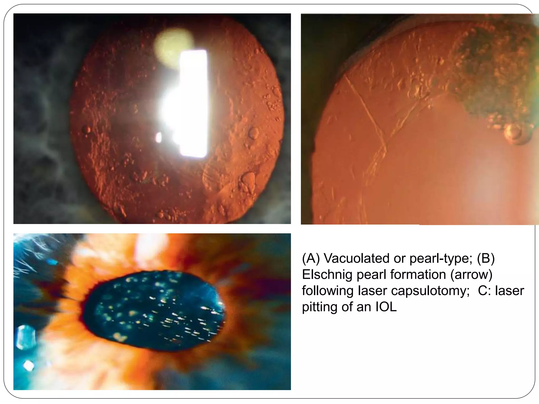 Laser (introduction and indication in posterior segments | PPTX