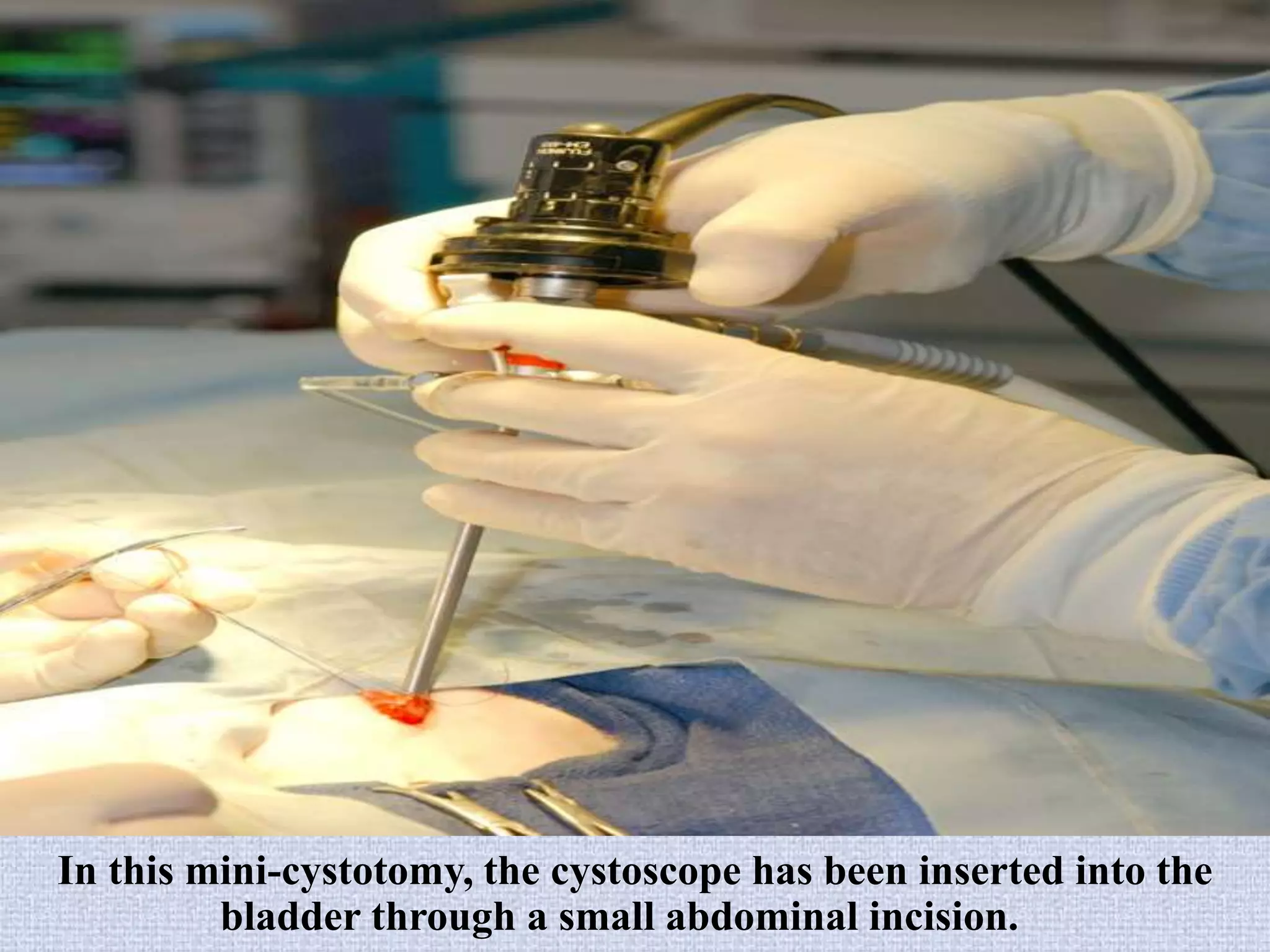 Laser Lithotripsy.pptx