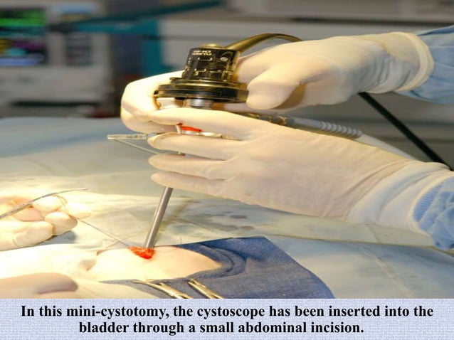 Laser Lithotripsy.pptx