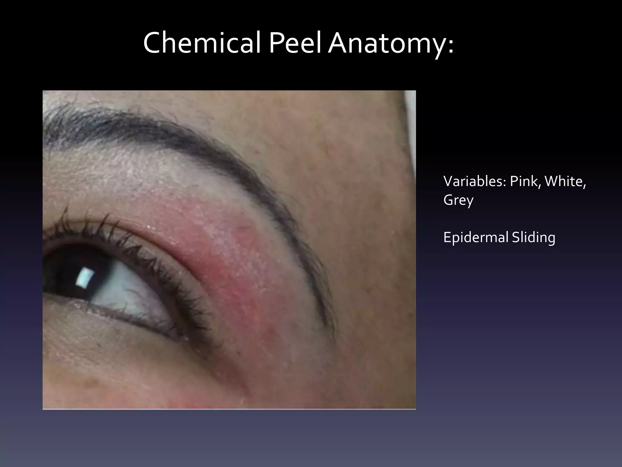 Laser Resurfacing, Dermabrasion, Chemical Peel In The Asian Ethnic ...