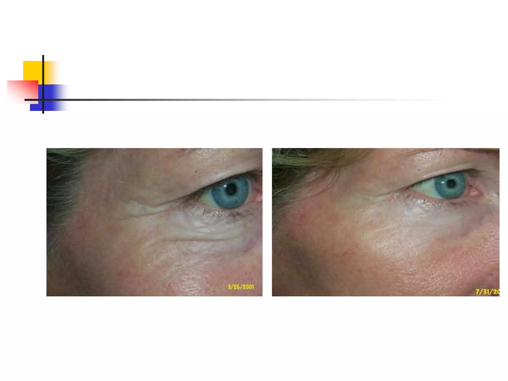 Lasers in surgery | PPTX