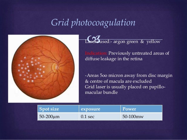 Lasers in ophthalmology