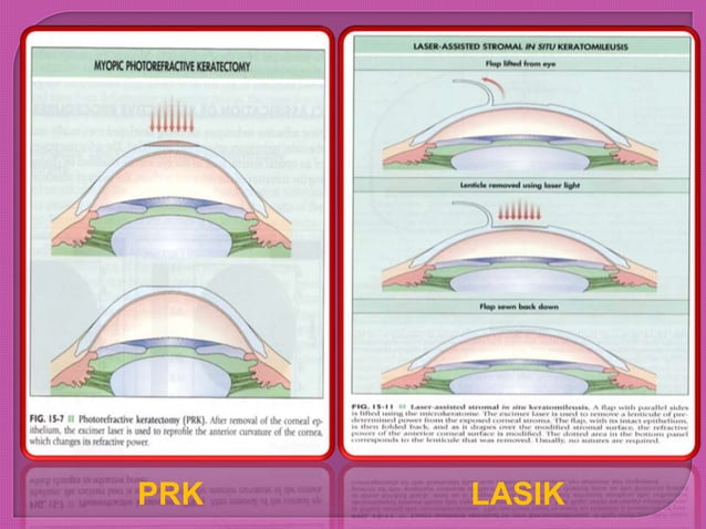 Lasers in ophthalmology | PPTX | Eye and Vision Conditions | Diseases ...