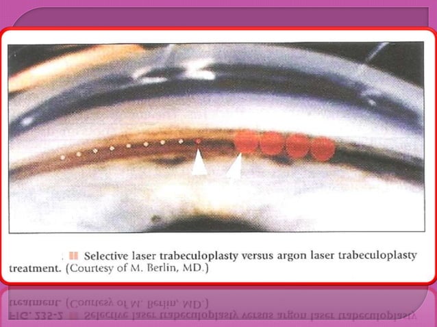 Lasers in ophthalmology | PPTX | Eye and Vision Conditions | Diseases ...