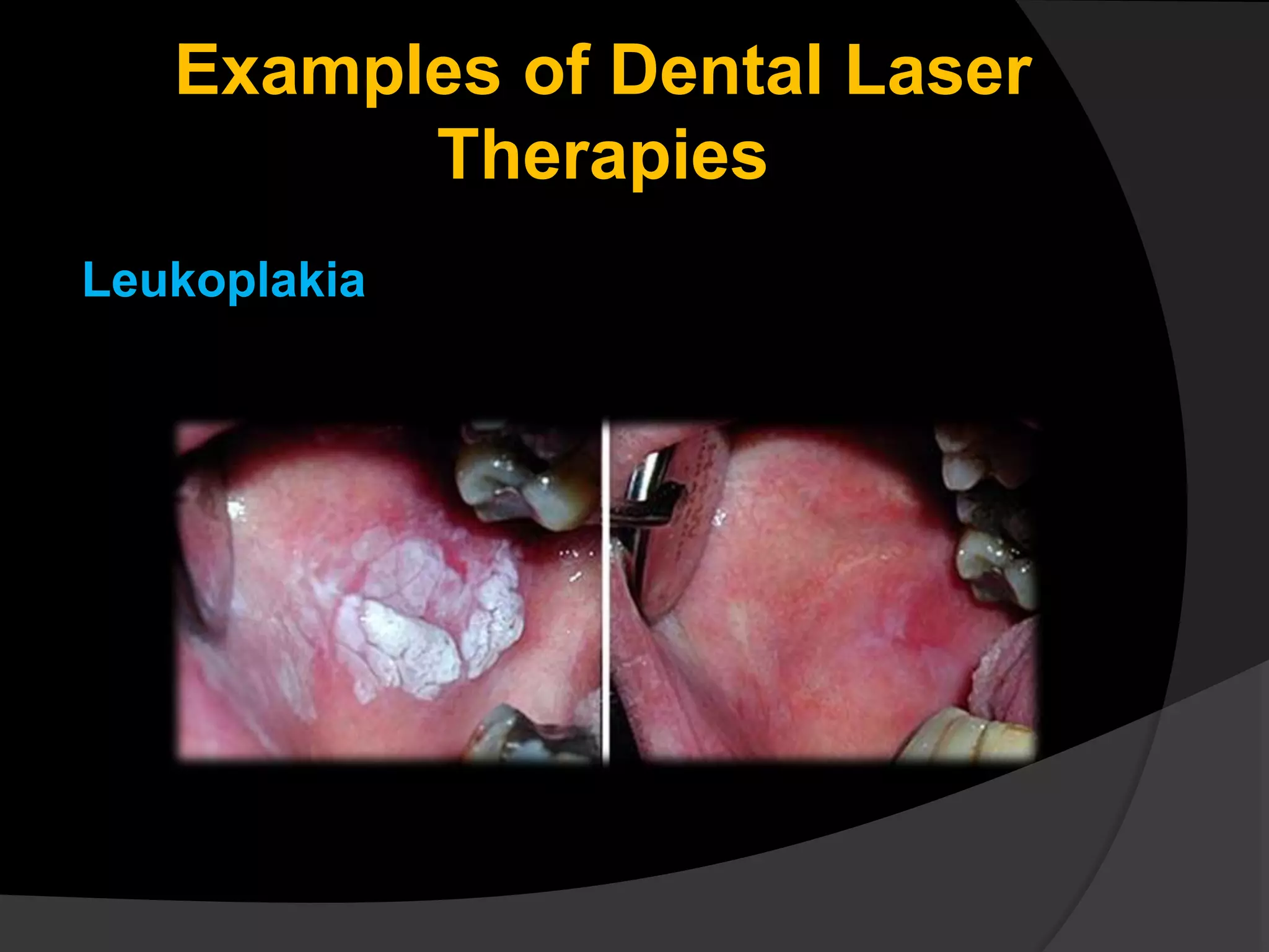 Lasers in Dentistry | PPTX