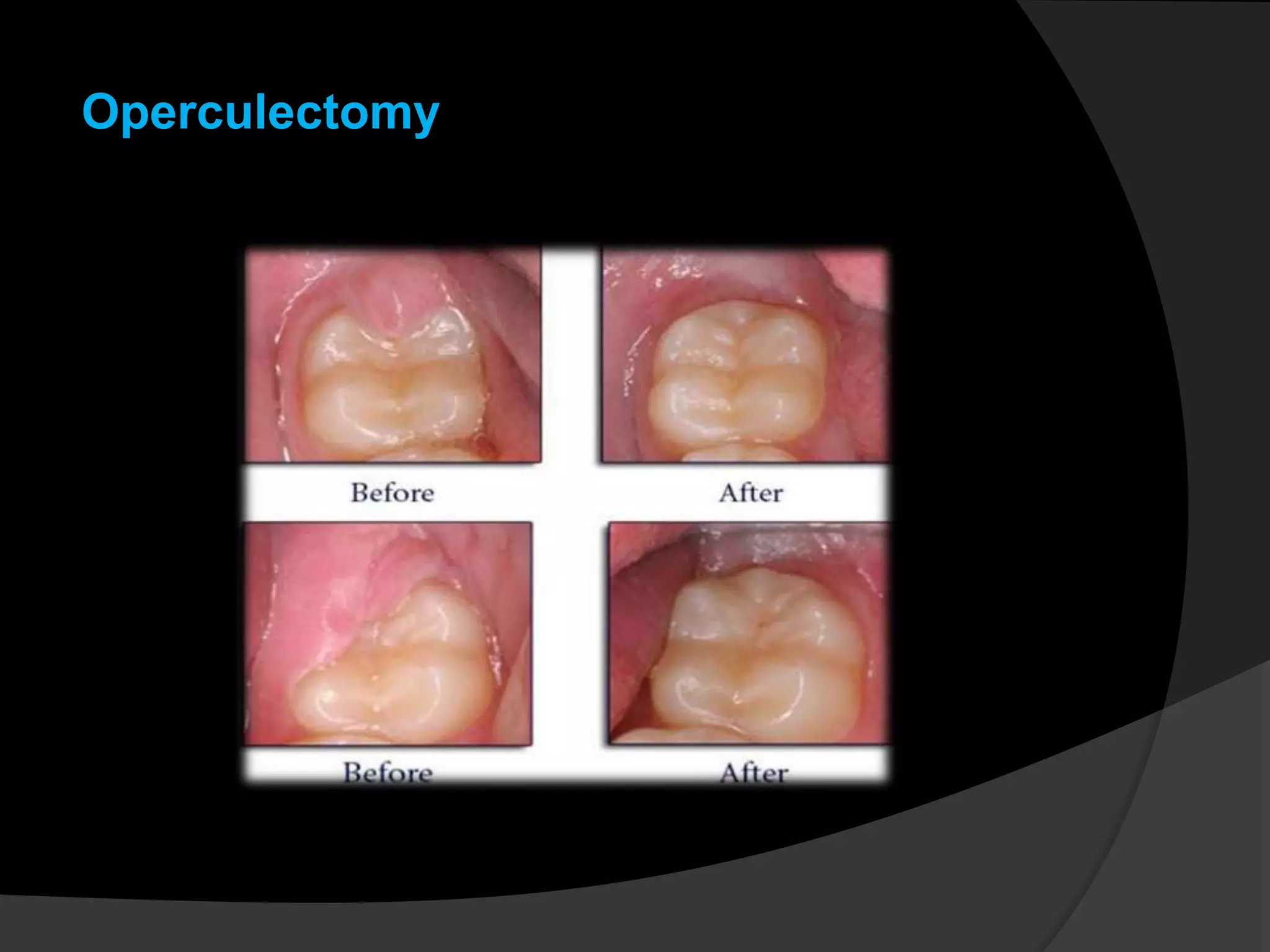 Lasers in Dentistry | PPTX