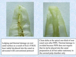 LASERS IN ENDODONTICS | PPTX